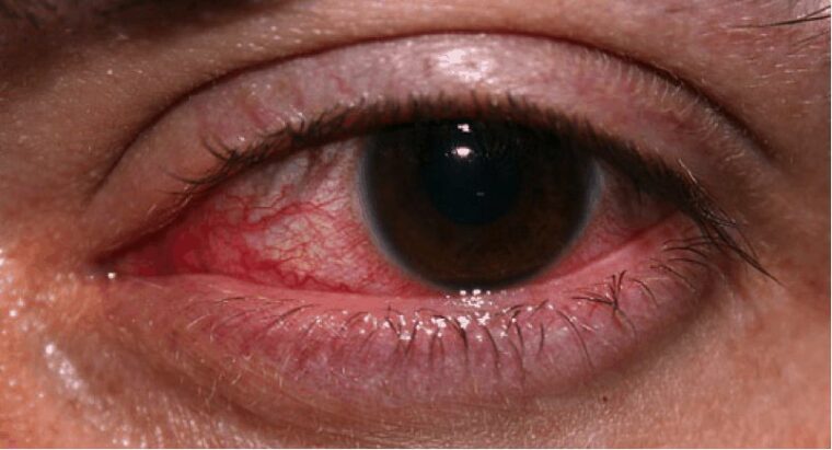 Blurred Vision After Lasik: How It Feels, Causes And Tips To Manage