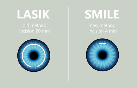 Smile Laser Eye Surgery: Meaning, Procedure, Benefits And Risks