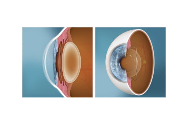 Visian ICL: The Procedure, Benefits And Side Effects